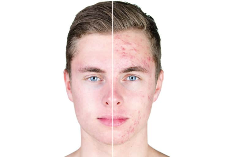 Behandlung von Akne & Rosazea & periorale Dermatitis – Dr. Helene ...